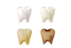 5 Foods that Stain Your Teeth - Valley Dental Practice